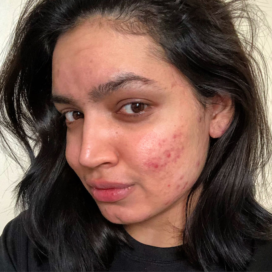 Woman Gets Dropped From L’Oréal’s Campaign Because Of Her Acne, She ...