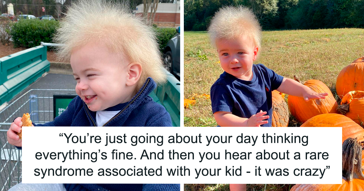 Happy Toddler Diagnosed With Uncombable Hair Syndrome Shows There Is No ...