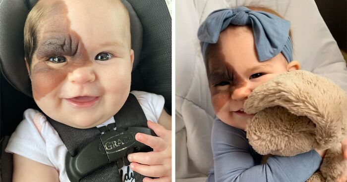 Mom Shares Her Daughter’s Unique Birthmark, Gathering 300k Followers ...
