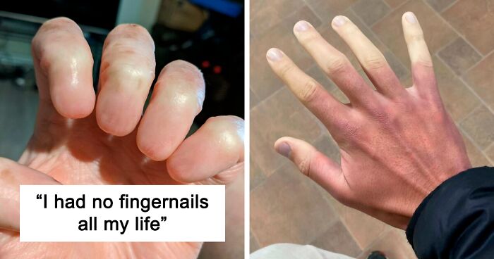 50 Photos Of Unique People That Show That Genetics Is Hard To Predict ...