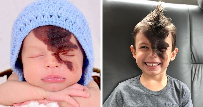 Societal Judgement Towards Enzo’s Mark On His Face Encouraged His Mom ...