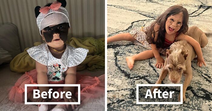 This 4-Year-Old Girl Has Undergone Multiple Surgeries To Get A ...
