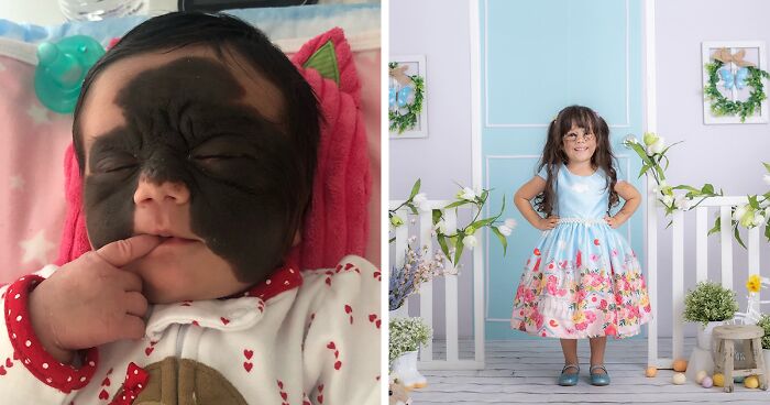 This 4-Year-Old Girl Has Undergone Multiple Surgeries To Get A ...