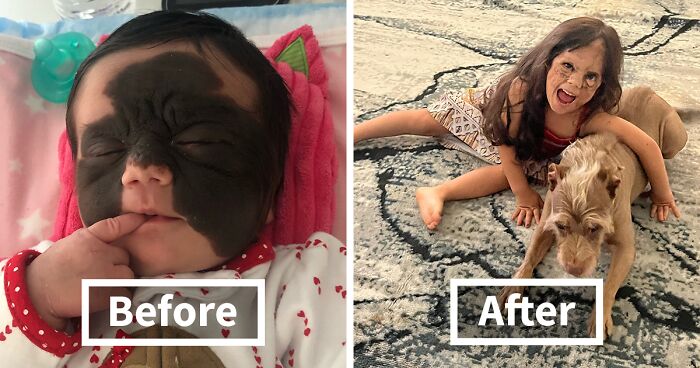 This 4-Year-Old Girl Has Undergone Multiple Surgeries To Get A ...