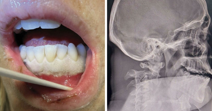40 Bizarre And Inspiring Medical Cases That People Shared On This ...