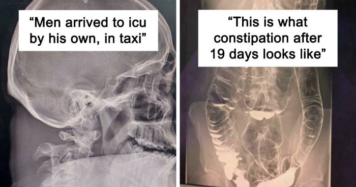 40 Bizarre And Inspiring Medical Cases That People Shared On This ...
