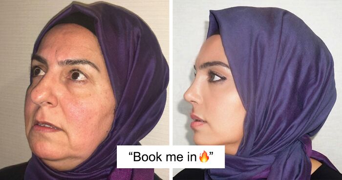 Before And After Photos From Turkish Plastic Surgery Clinic Have Left ...