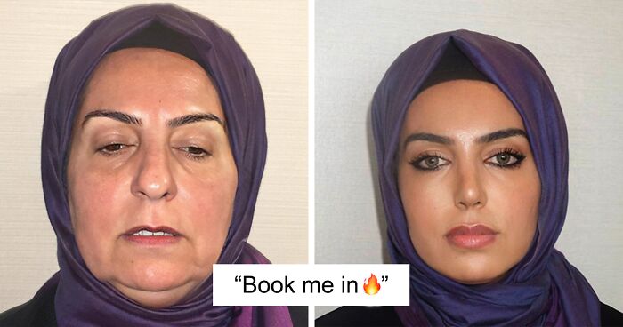 Before And After Photos From Turkish Plastic Surgery Clinic Have Left People Baffled