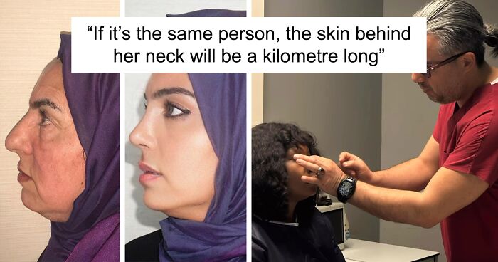 Before And After Photos From Turkish Plastic Surgery Clinic Have Left ...