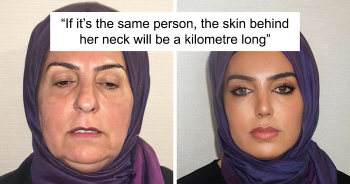 Before And After Photos From Turkish Plastic Surgery Clinic Have Left ...