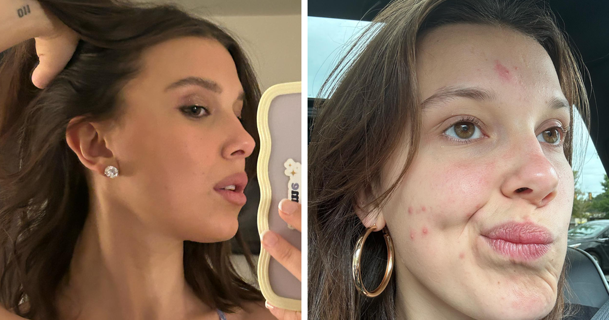 Stranger Things’ Millie Bobby Brown Embraces Acne Breakout, And The ...