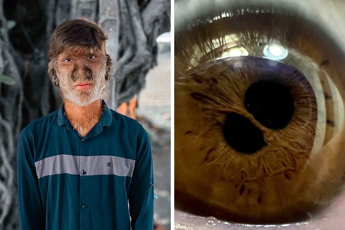 50 Times Human Genetics Led To Some Unique Body Characteristics | Bored ...