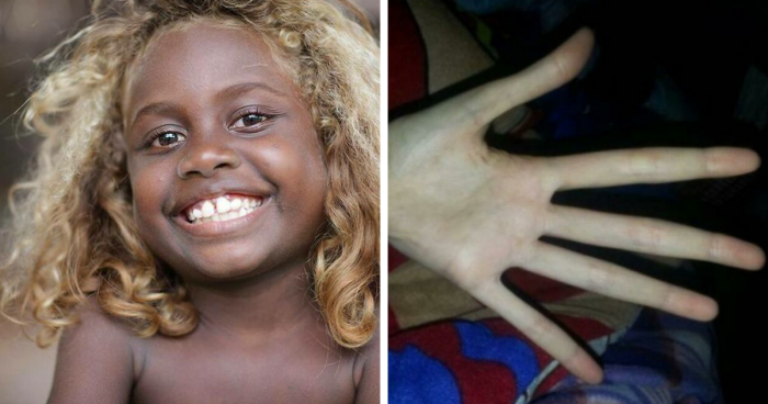 50 Times Human Genetics Led To Some Unique Body Characteristics