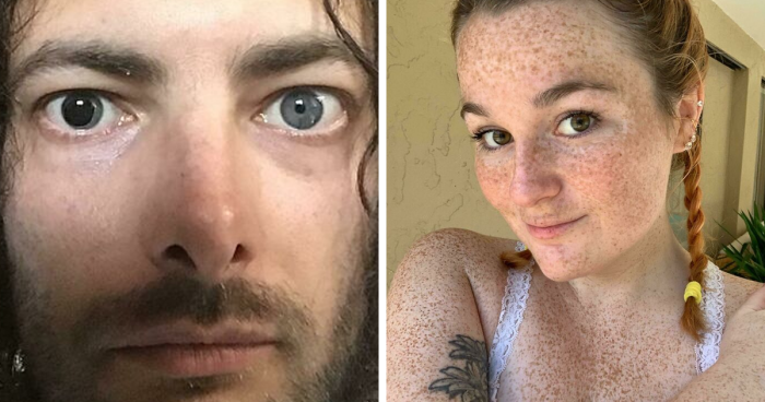 50 Times Human Genetics Led To Some Unique Body Characteristics