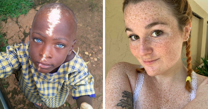 50 Times Human Genetics Led To Some Unique Body Characteristics