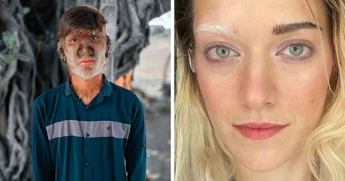 50 Times Human Genetics Led To Some Unique Body Characteristics