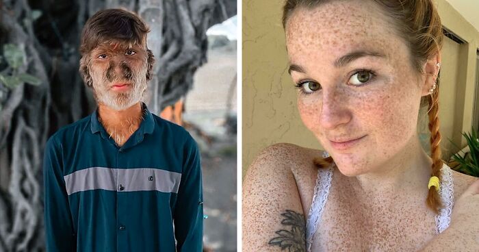 50 Times Human Genetics Led To Some Unique Body Characteristics