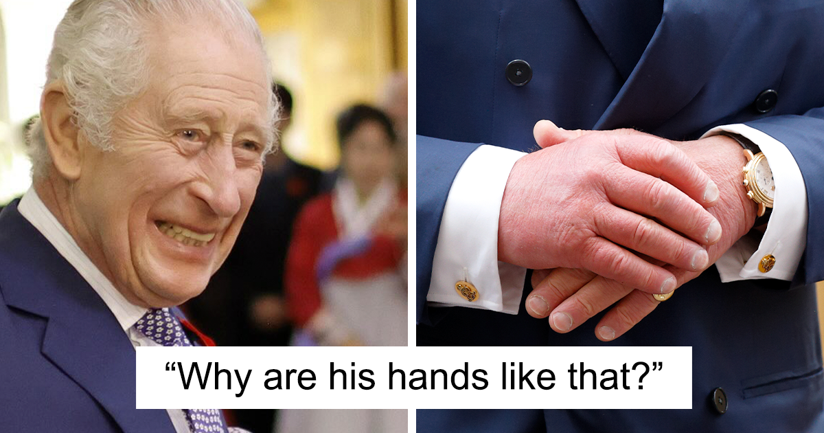 “Glad He Has A Sense Of Humor”: King Charles Roasts His Own Fingers In ...