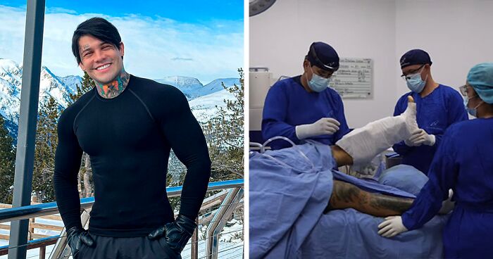 Influencer Spends $175,000 On “Most Painful” Leg-Lengthening Surgery To ...