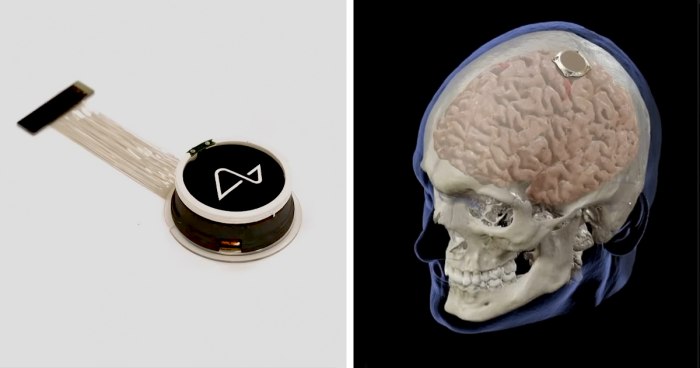 “That Is The Goal”: Elon Musk’s Neuralink Is Implanted In First-Ever ...