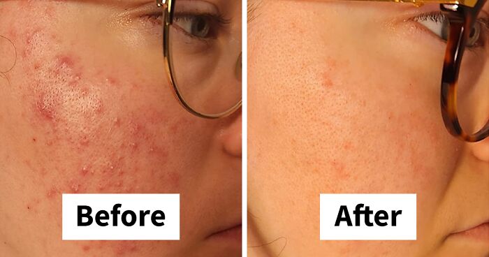 35 Beauty Solutions to Solve Embarrassing Problems | Bored Panda