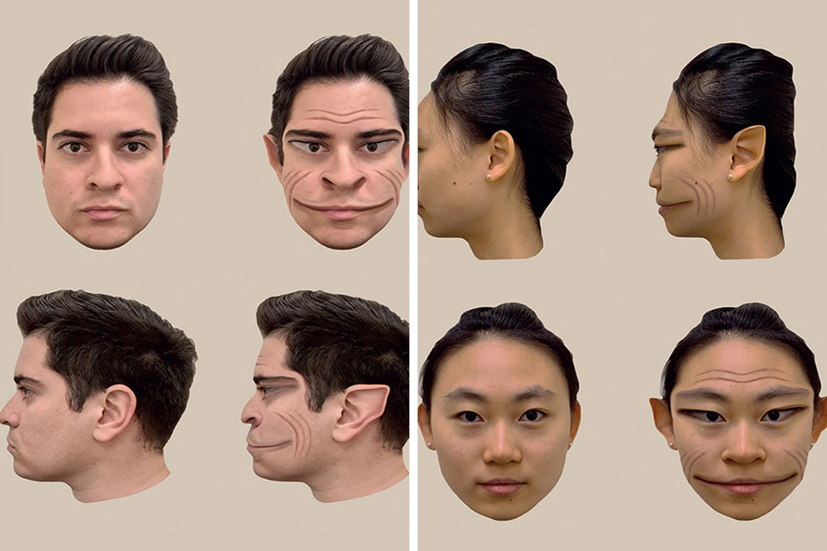 Man With Rare Disorder With Less Than 100 Reported Cases Sees People ...