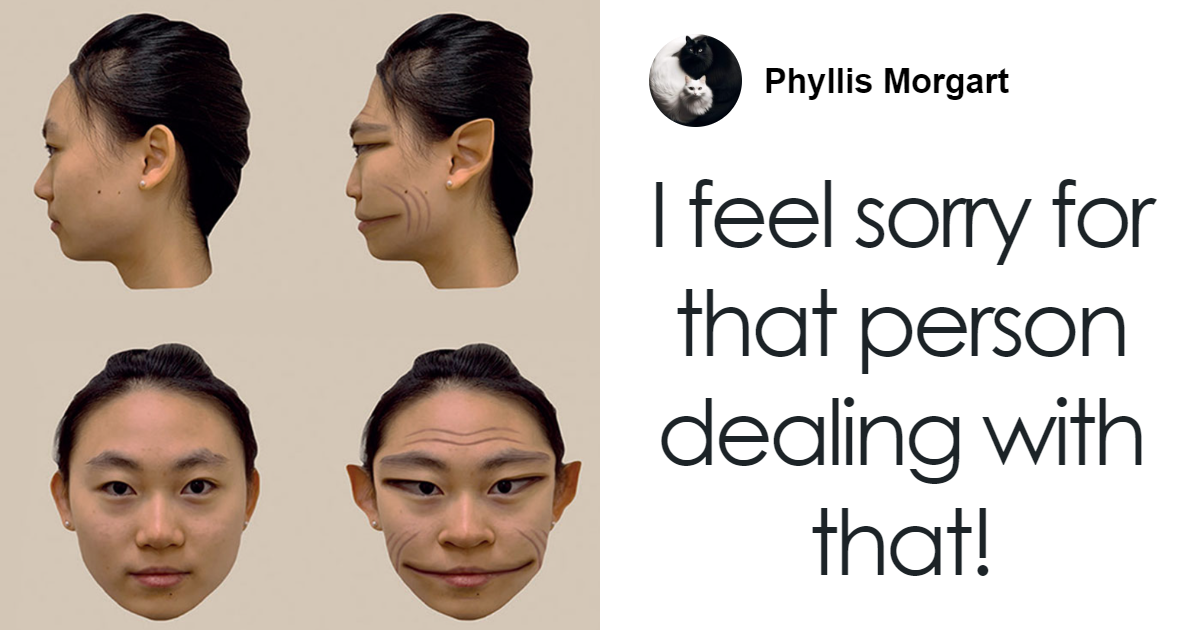 Man With Rare Disorder With Less Than 100 Reported Cases Sees People ...