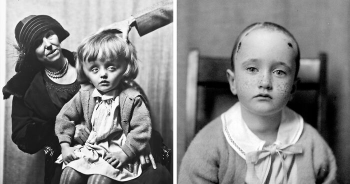 20 Haunting Medical Portraits Of Harvey Cushing’s Patients In The Early 20th Century | Bored Panda