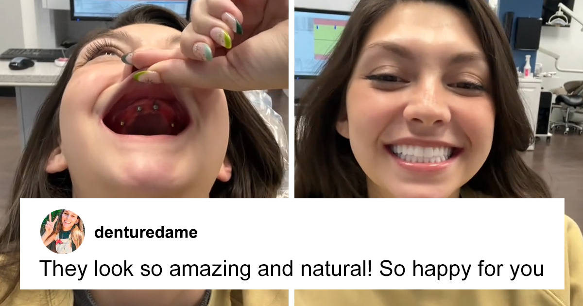 After Having All Her Teeth Pulled Out At 20, Woman Shares “Before/After ...