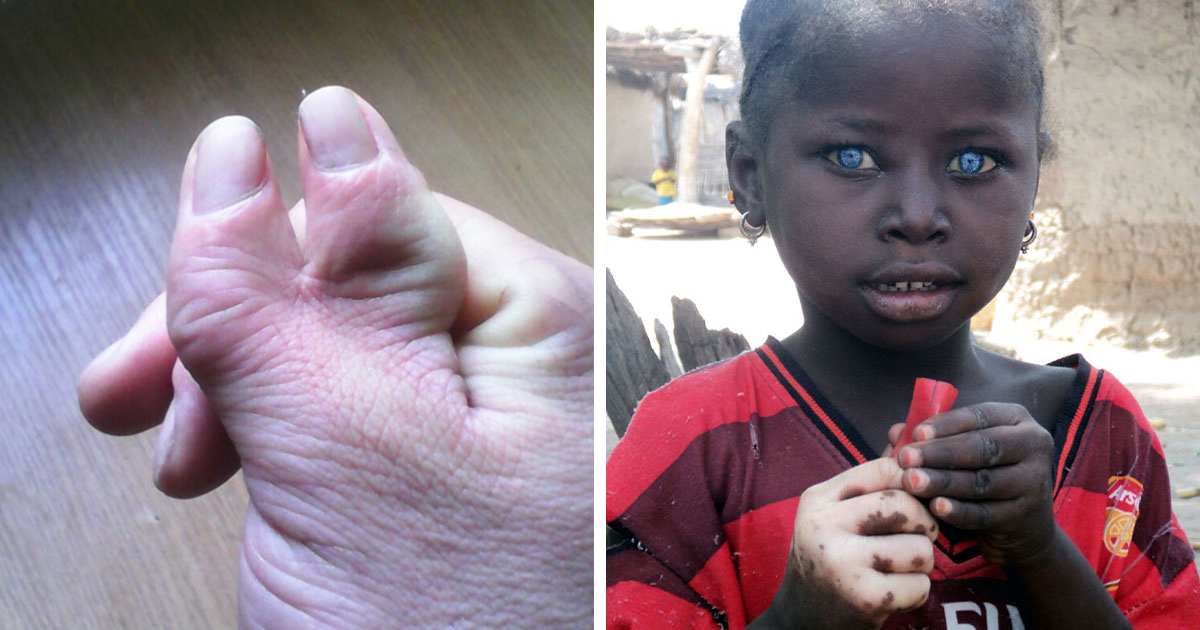 89 Photos Of Unique People That Show That Genetics Is Unpredictable ...