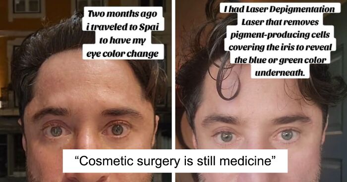 Patients Increasingly Changing Eye Color With Surgery Despite Over 90% ...