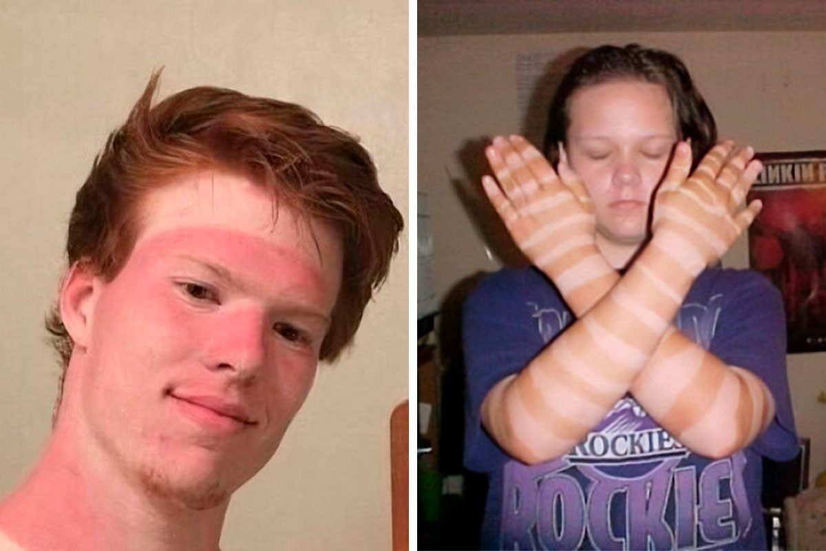 50 Times People Posted Their Embarrassing Sunbathing Fails So You Can ...