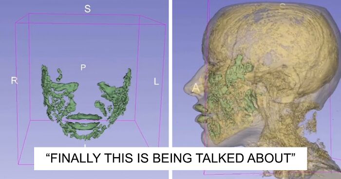 MRI Of 33-Year-Old Woman’s Face Reveals Where All Her Filler Went