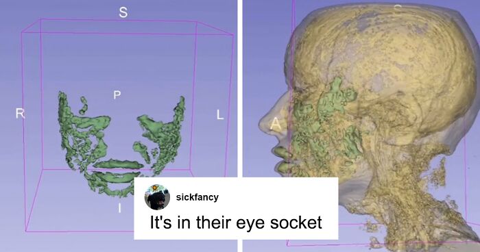 MRI Of 33-Year-Old Woman’s Face Reveals Where All Her Filler Went