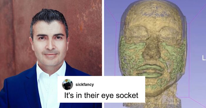 MRI Of 33-Year-Old Woman’s Face Reveals Where All Her Filler Went