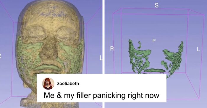 MRI Of 33-Year-Old Woman’s Face Reveals Where All Her Filler Went
