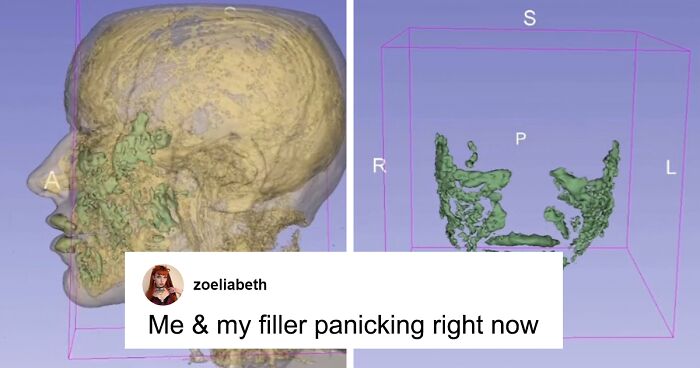 MRI Of 33-Year-Old Woman’s Face Reveals Where All Her Filler Went