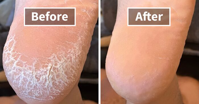 We’re Not Blushing Anymore: 18 Fixes For Those Embarrassing Body Probs