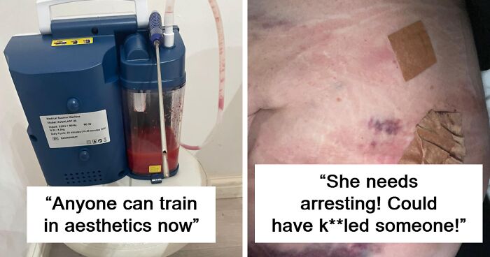 Woman Hospitalized After Liposuction Procedure Using AliExpress Dental ...