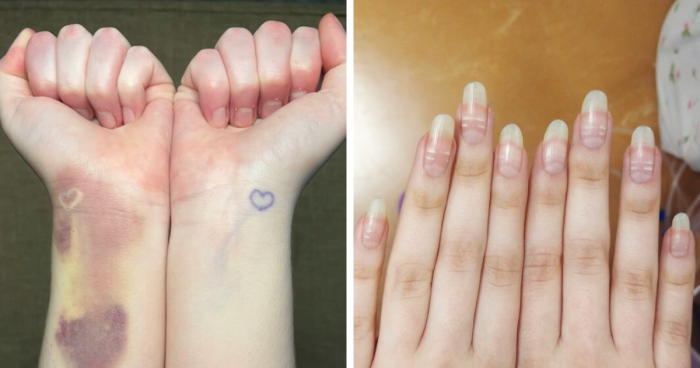 “My Eye Is Gradually Losing Its Color”: 50 Interesting Human Body Pics ...