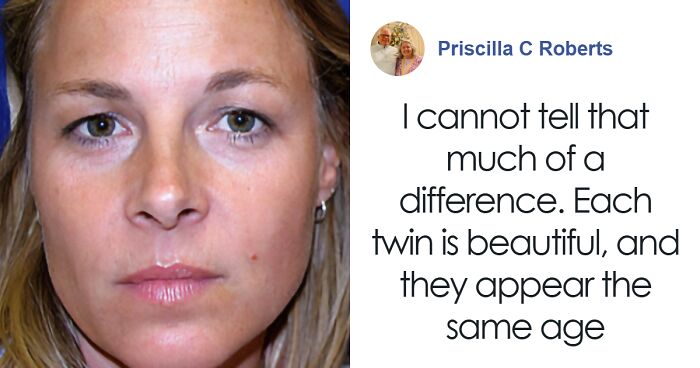 One Twin Ages Naturally, The Other Gets Botox, And Netizens Compare Both