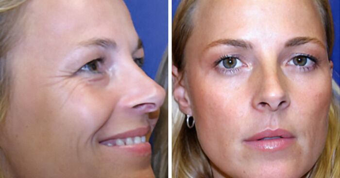 One Twin Ages Naturally, The Other Gets Botox, And Netizens Compare Both