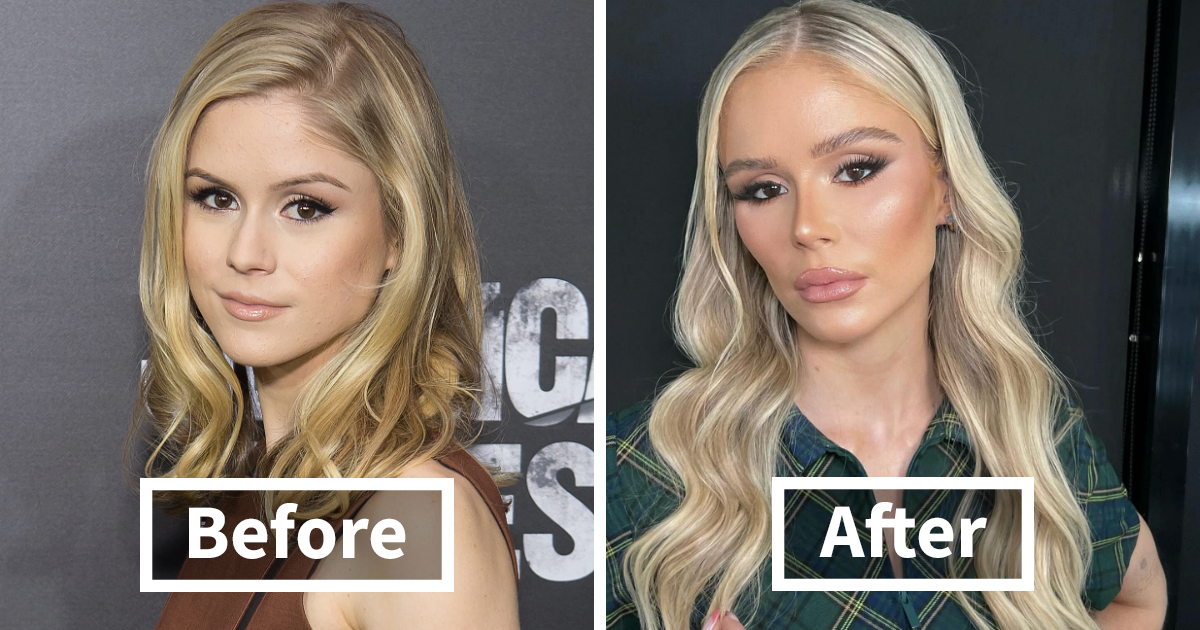 Famous Celebrities Unrecognizable After Plastic Surgery Gone Wrong Famous Celebrities Unrecognizable After Plastic Surgery Gone Wrong
