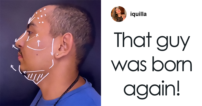 “How Scary”: Patient’s Plastic Surgery Results That Took Decades Off ...