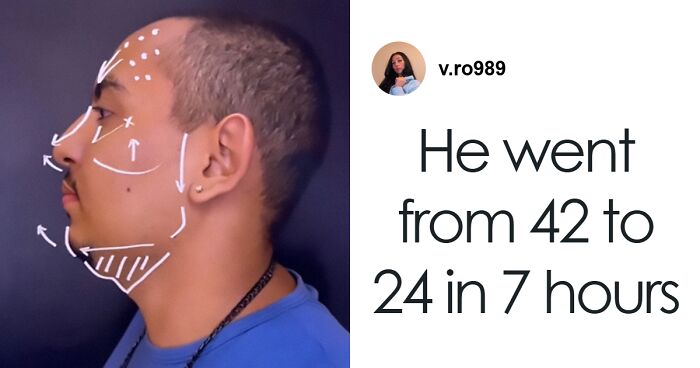 “How Scary”: Patient’s Plastic Surgery Results That Took Decades Off ...