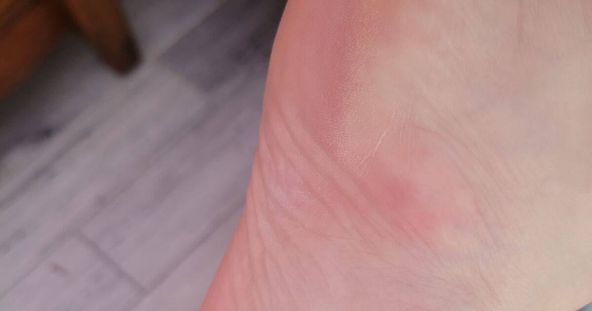 Hey Pandas, What Was The Worst Place You’ve Gotten Bitten By A Bug Or ...