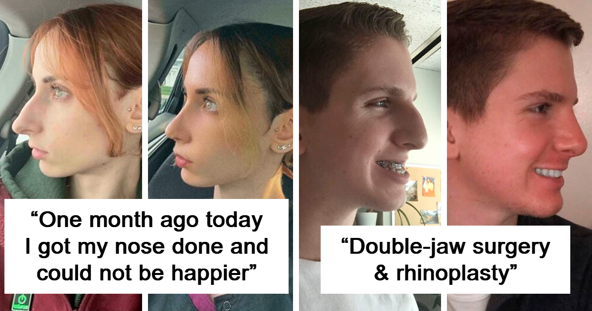 50 People Who Look Unrecognizable After Plastic Surgery | Bored Panda