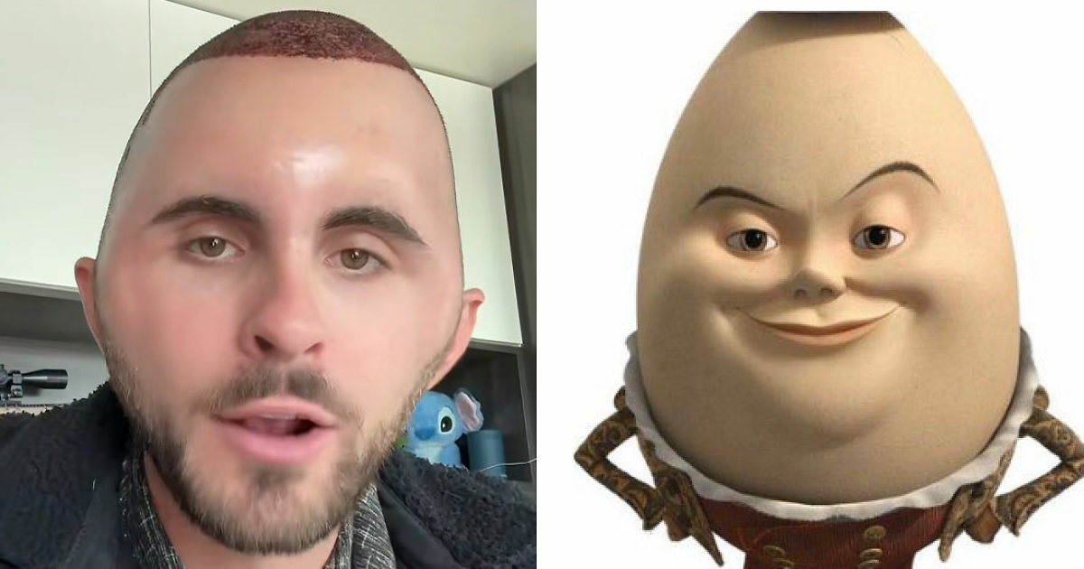 TikToker Goes Viral After Hair Transplant Swelling Turns Him Into A ...