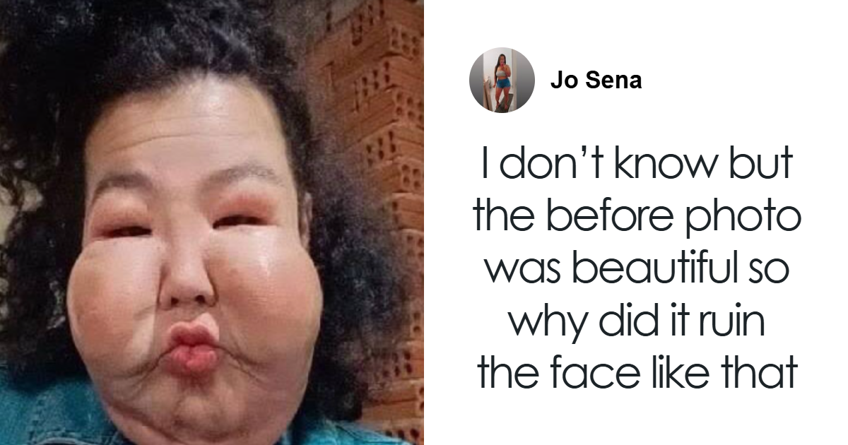 Influencer Brutally Disfigured In Botched Plastic Surgery Gets A Second ...