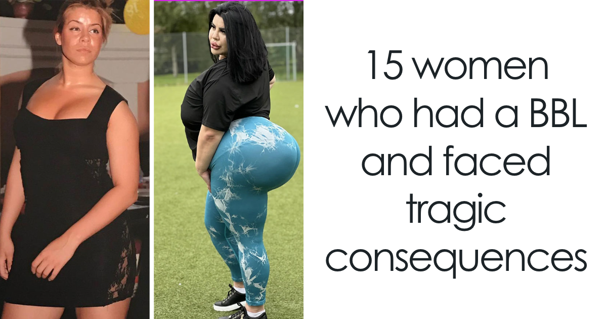 15 Women Who Had A BBL And Faced Tragic Consequences In Their Quest For ...